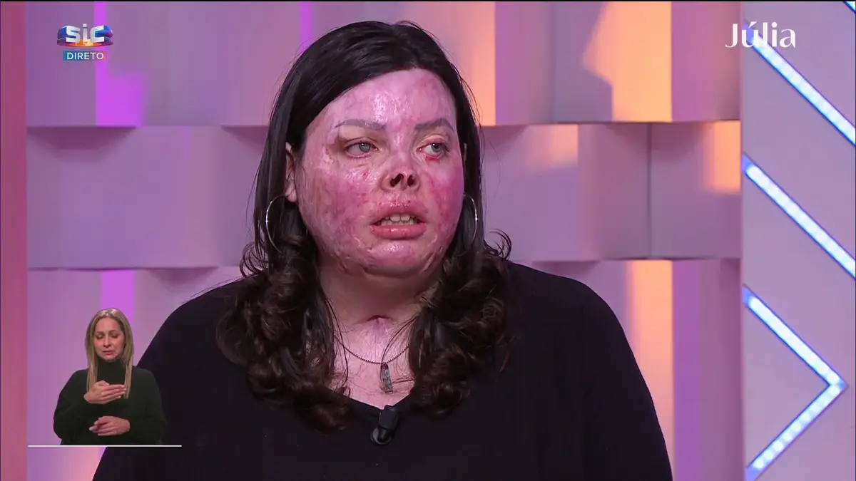 Rafaela ficou com 85% do corpo queimado ao tentar salvar o pai de uma ...