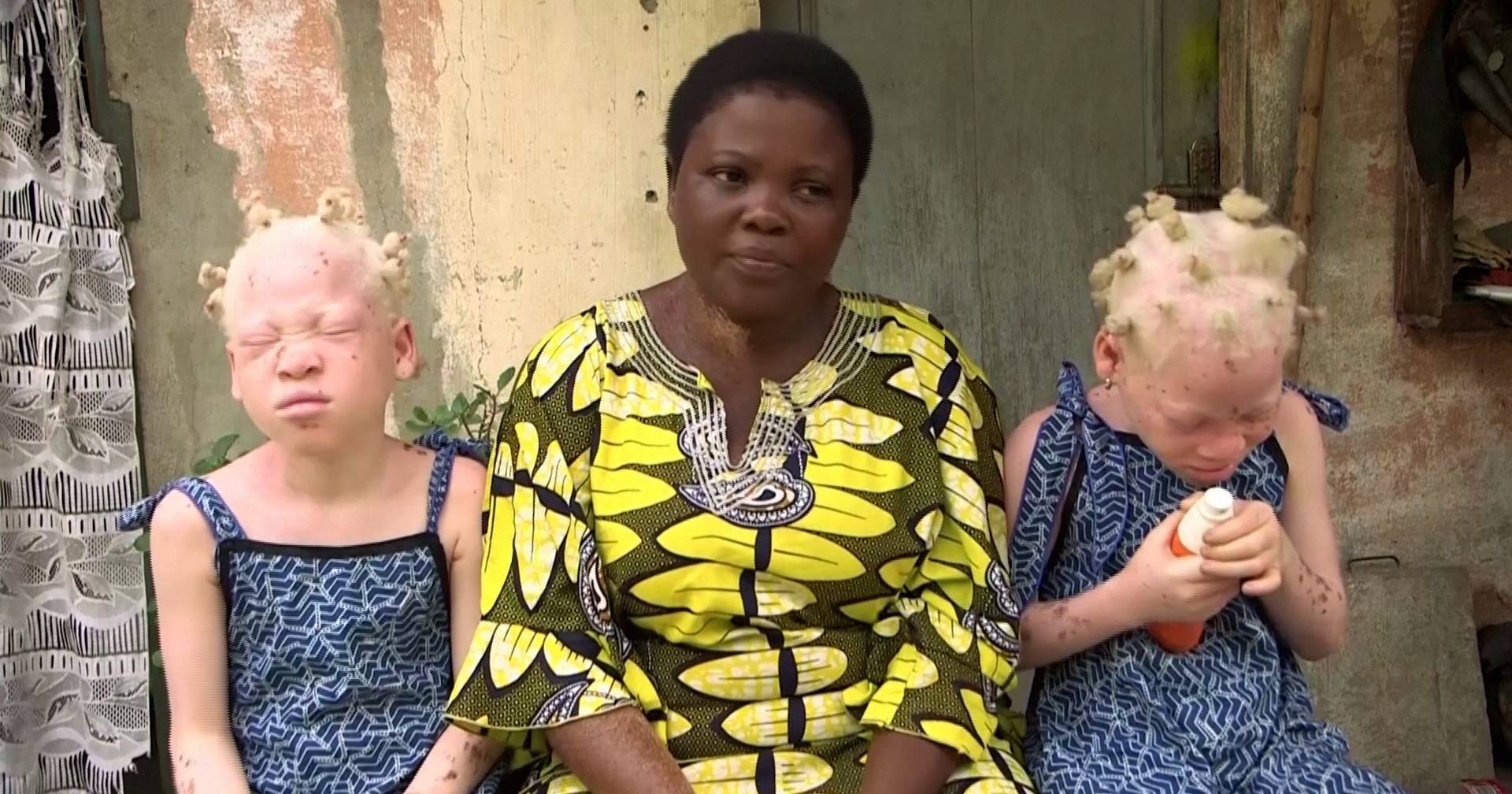 Albinos precisam de proteção cada vez maior com o calor extremo em ...